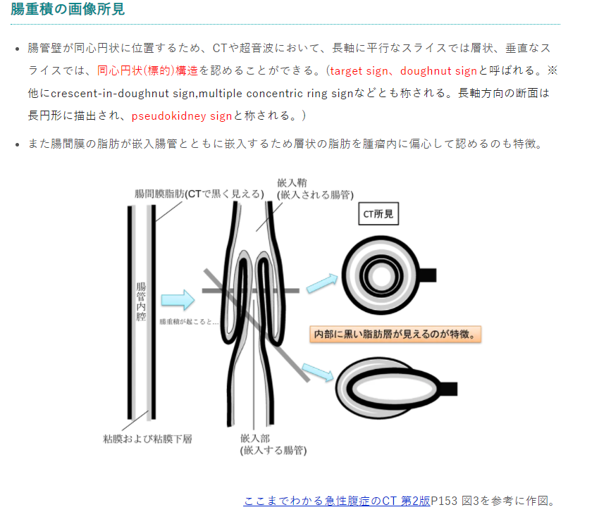 【第30回】外部講師による勉強会～腸重積lymphom～ - 株式会社ワイズ・リーディング | 遠隔画像診断サービスで、医師の働き方改革を実現 ...